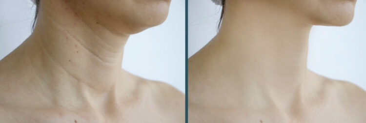 Botox injections – Cost, Procedure, Benefits, Side Effects & More ...