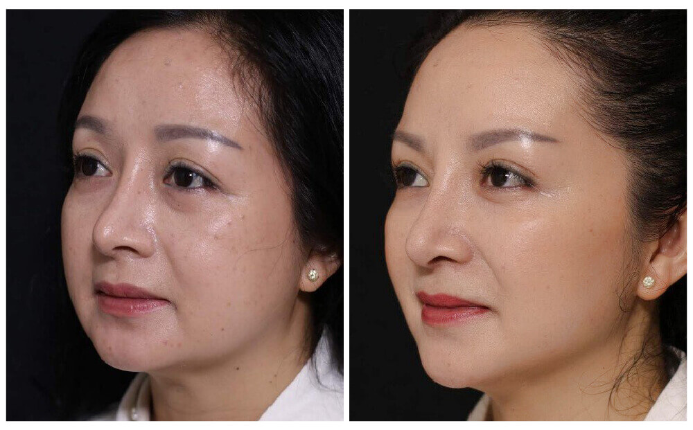 Dermal Filler - Cost, Types, Benefits, Side Effects & More