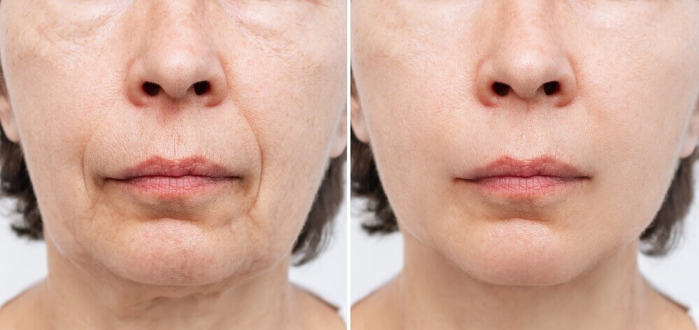 Thermage Treatment – Non-Surgical Skin Tightening - SIAN Skin Clinic