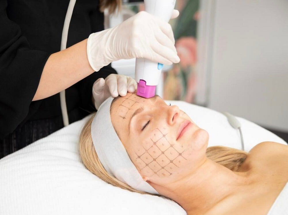 Thermage Treatment – Non-Surgical Skin Tightening - SIAN Skin Clinic