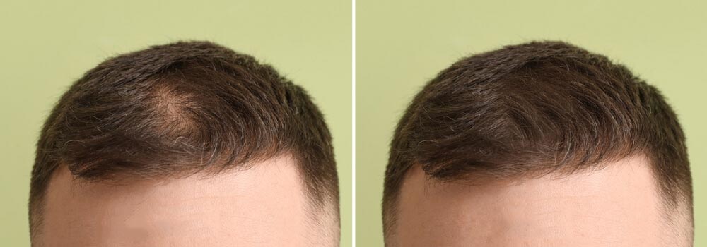 Mesotherapy Injections for Face, Neck and Hair - SIAN Skin Clinic