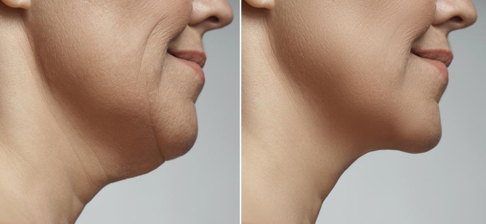 Thread Lift: What to Expect, Cost, Risk, Procedures and More - SIAN ...
