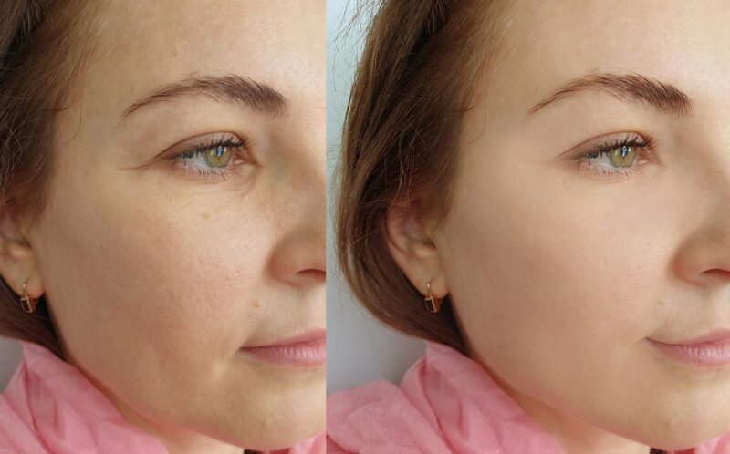 Skin Resurfacing with Helios Laser Treatment - SIAN Skin Clinic