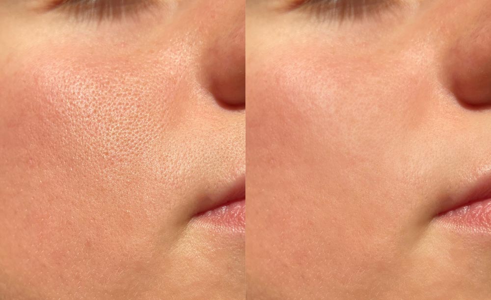 Skin Resurfacing with Helios Laser Treatment - SIAN Skin Clinic