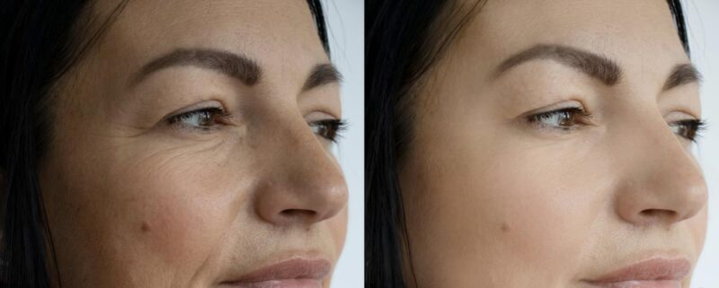 Venus Viva Nanofractional RF – Wrinkle Removal, Skin Resurfacing - SIAN ...