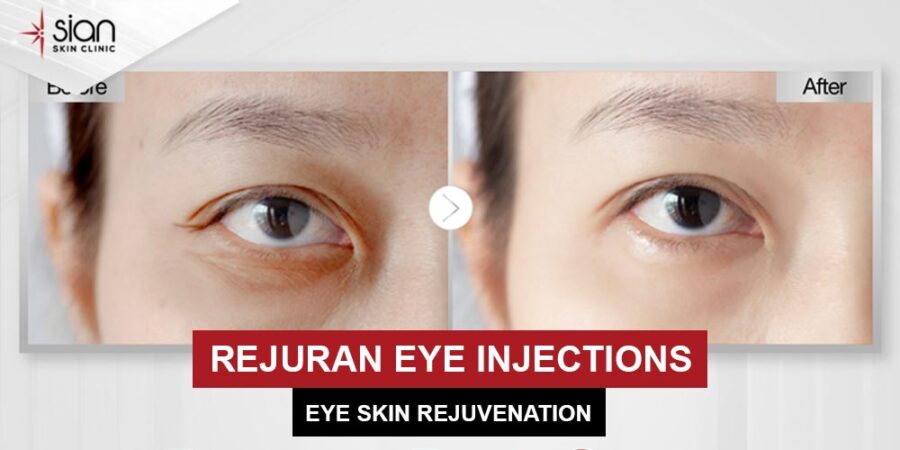5 Benefits of Rejuran Eye Injection Treatment - SIAN Skin Clinic