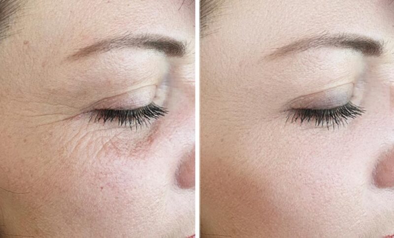5 Benefits of Rejuran Eye Injection Treatment - SIAN Skin Clinic