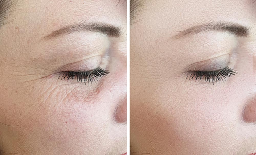 5 Benefits of Rejuran Eye Injection Treatment - SIAN Skin Clinic
