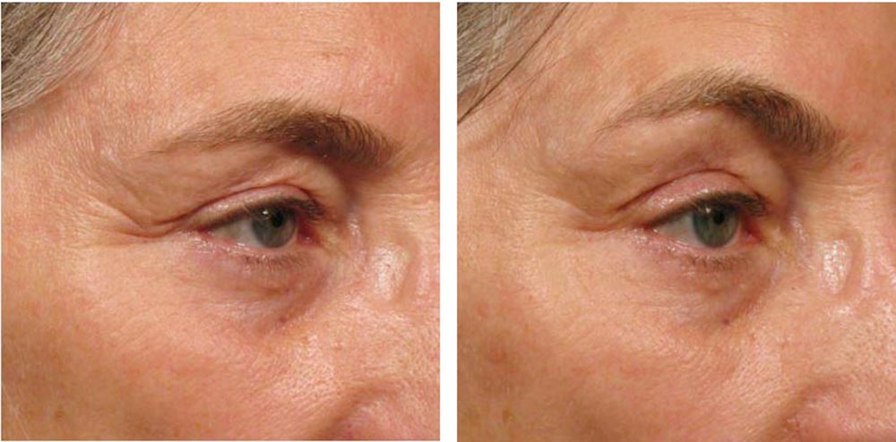 Ultherapy Prime – The Best Skin Tightening & Lifting - SIAN Skin Clinic