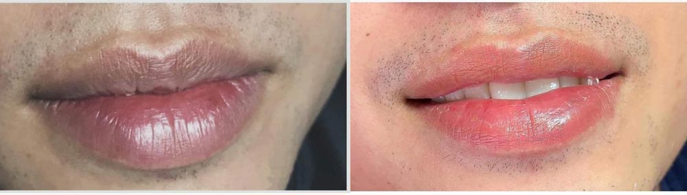 Fractional CO2 Laser Resurfacing: Benefits, Recovery, Before - After ...