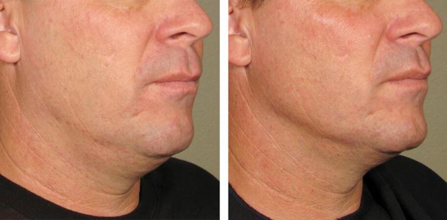 Ultherapy Prime – The Best Skin Tightening & Lifting - SIAN Skin Clinic