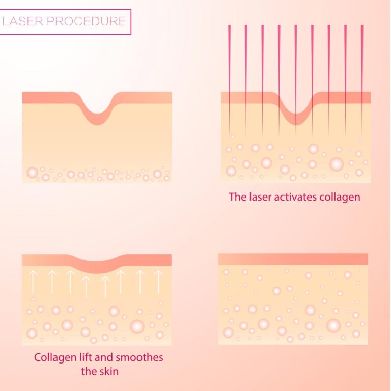 Fractional CO2 Laser Resurfacing: Benefits, Recovery, Before - After ...