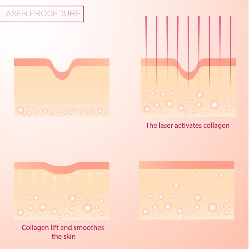 Fractional CO2 Laser Resurfacing: Benefits, Recovery, Before - After ...