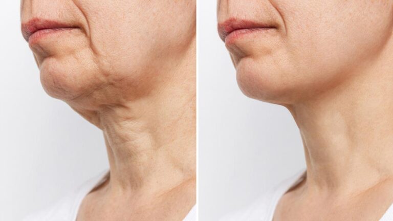 Ultherapy Prime – The Best Skin Tightening & Lifting - SIAN Skin Clinic