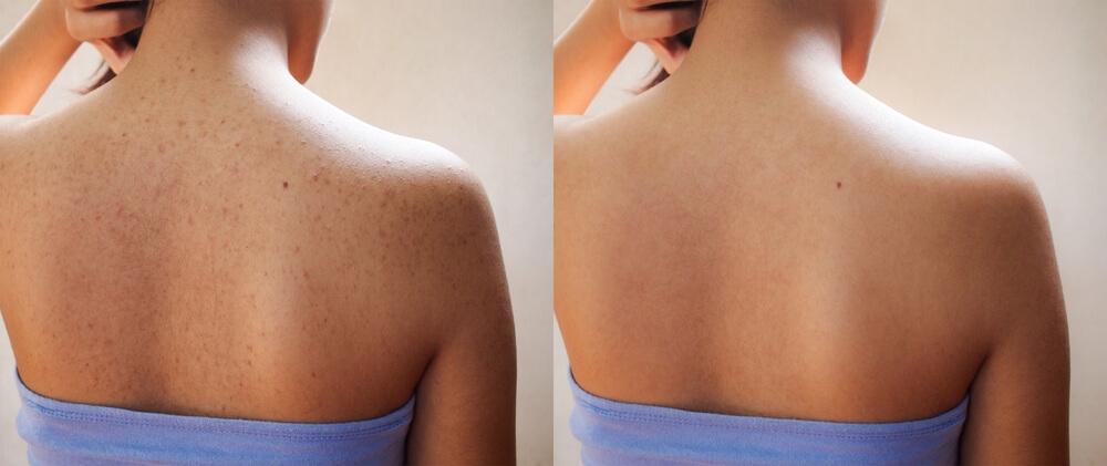 Salicylic Acid Peel - Effective for Acne and Post-Acne Marks - SIAN ...