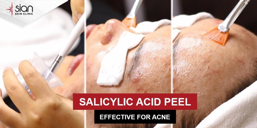 Salicylic Acid Peel - Effective for Acne and Post-Acne Marks - SIAN ...
