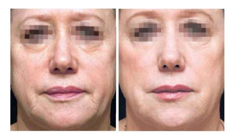 Profhilo BAP Technique – Before and After Treatment - SIAN Skin Clinic