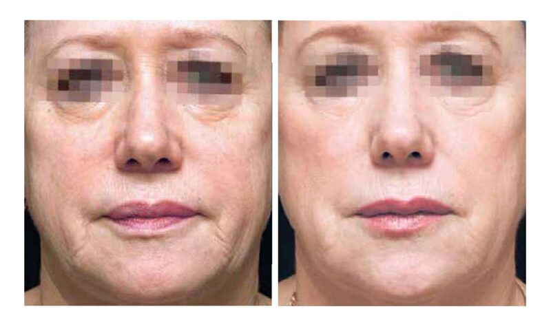 Profhilo BAP Technique – Before and After Treatment - SIAN Skin Clinic