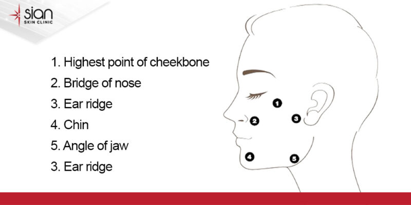 Profhilo BAP Technique – Before and After Treatment - SIAN Skin Clinic