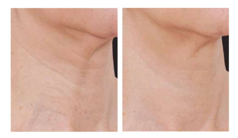 Profhilo BAP Technique – Before and After Treatment - SIAN Skin Clinic