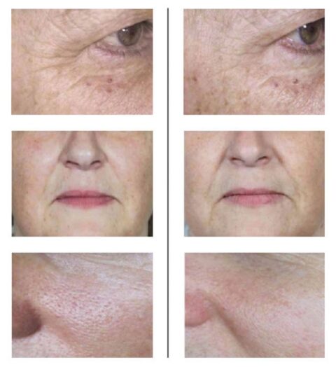 NCTF 135 HA Injections – The Secret to Radiant Skin - SIAN Skin Clinic