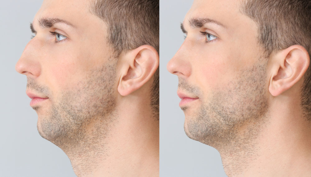 Dermal Fillers for Men Before & After: The Transformation Will Surprise ...